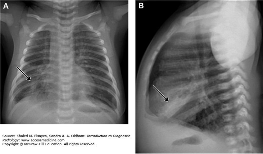 Raio X De Pneumonia Viral Chest X Ray Bronchitis Vs Pneumonia
