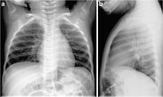 rx pneumonia viral 2 – PediatriaVirtual.com