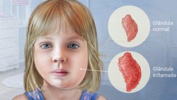 Íngua ou Linfonodo – PediatriaVirtual.com